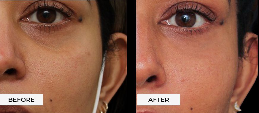 Modern Solutions for Under-Eye Conditions - Time Clinic