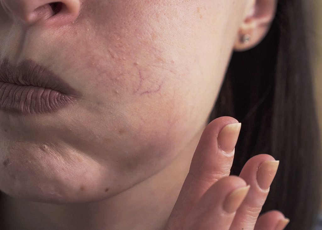 Facial Thread Veins - Time Clinic